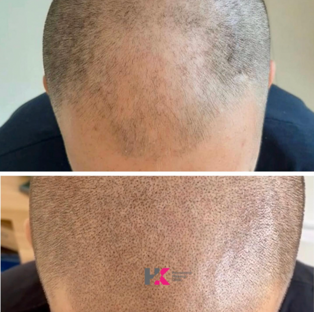 Professional Permanent Cosmetic Procedures – hkclinic